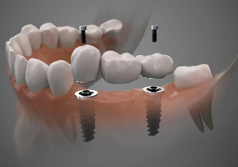 Implante Prótese Fixa Protocolo Como Funciona? - Oral Unic